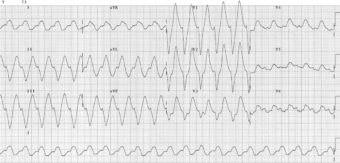 Tricyclic Overdose • LITFL • ECG Library
