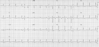 Tricyclic Overdose • LITFL • ECG Library