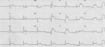 The ST Segment • LITFL • ECG Library Basics