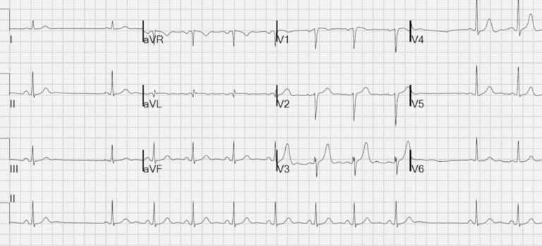 Sinoatrial Exit Block • LITFL • ECG Library Diagnosis