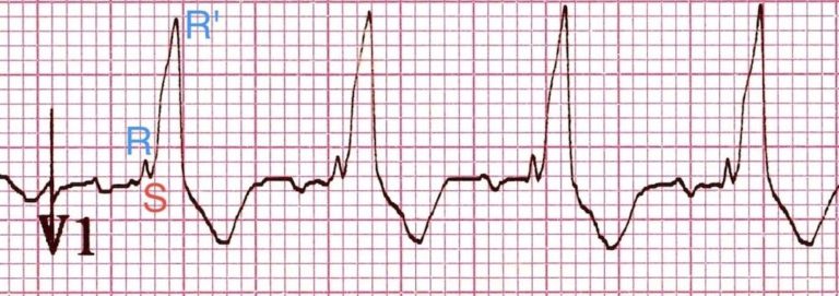 VT versus SVT • LITFL Medical Blog • ECG Library Basics