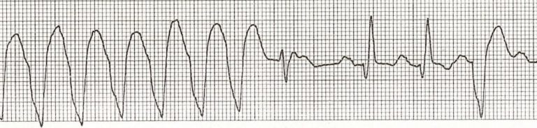 ECG Case 046 • LITFL • ECG Top 100 Self-Assessment Quiz