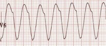 VT versus SVT • LITFL Medical Blog • ECG Library Basics
