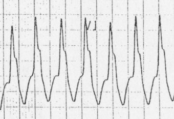 VT versus SVT • LITFL Medical Blog • ECG Library Basics