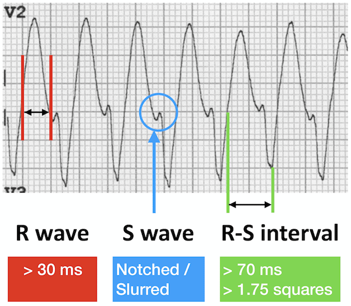 Ecg Case 047 Litfl Ecg Top 100 Self Assessment Quiz Free Nude Ecg Case 047 Litfl Ecg Top 100 Self Assessment Quiz Free Nude