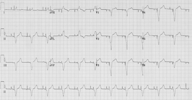 The ST Segment • LITFL • ECG Library Basics