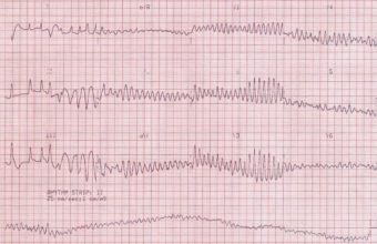 Ventricular Fibrillation (VF) • LITFL • ECG Library Diagnosis