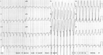 Pre-excitation syndromes • LITFL • ECG Library Diagnosis
