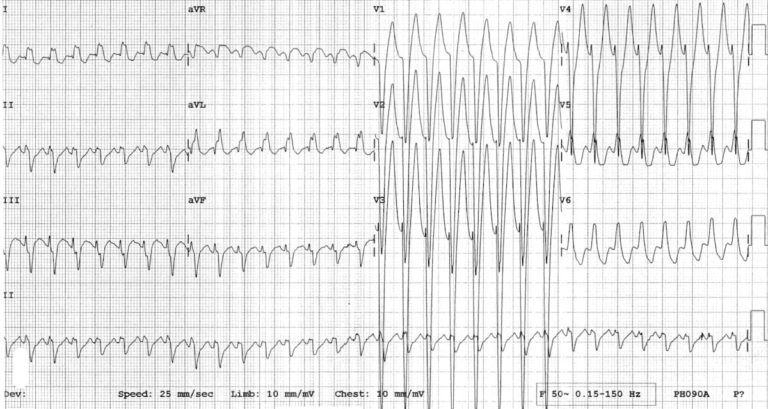 Pre-excitation syndromes • LITFL • ECG Library Diagnosis