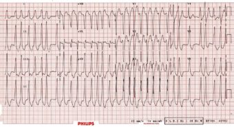 Pre-excitation syndromes • LITFL • ECG Library Diagnosis