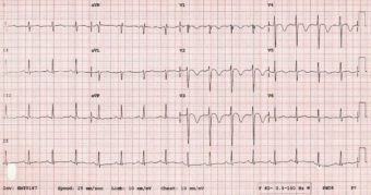 Wellens Syndrome • LITFL • ECG Library Eponym