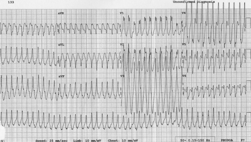 Common paediatric arrhythmias • LITFL • ECG Library Diagnosis