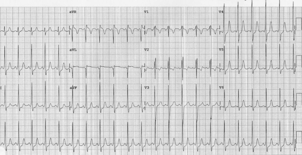 Paediatric ECG Interpretation • LITFL • ECG Library Basics Paediatric ECG Interpretation • LITFL • ECG Library Basics