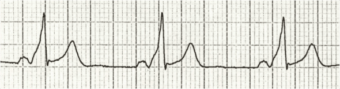 Delta Wave • LITFL Medical Blog • ECG Library Basics