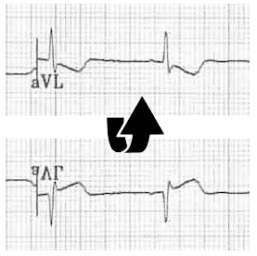 Inferior STEMI • LITFL • ECG Library Diagnosis