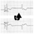 Inferior STEMI • LITFL • ECG Library Diagnosis