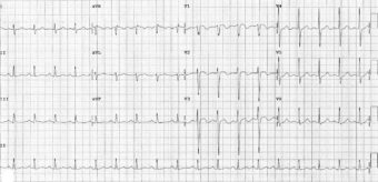 ECG changes in Pulmonary Embolism • LITFL • ECG Library