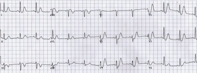 The ST Segment • LITFL • ECG Library Basics