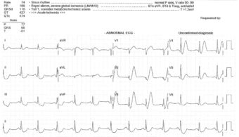 De Winter T Wave • LITFL • ECG Library Diagnosis