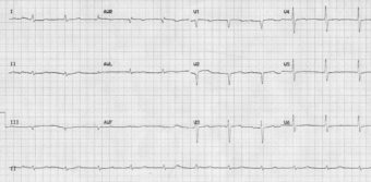 Hypothyroidism ECG changes • LITFL • ECG Library