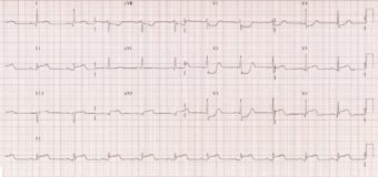 Lateral STEMI ECG changes • LITFL • ECG Library Diagnosis