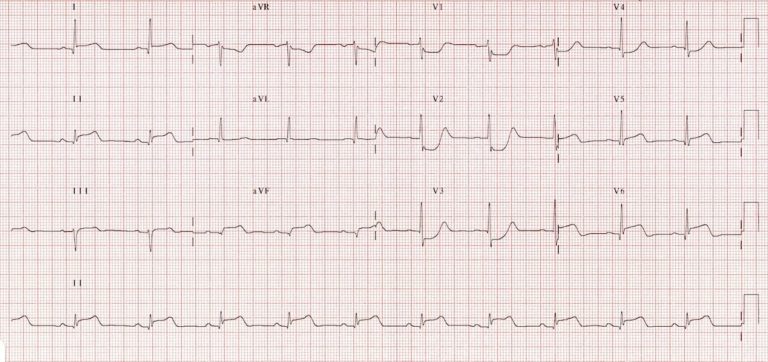 Lateral STEMI ECG changes • LITFL • ECG Library Diagnosis