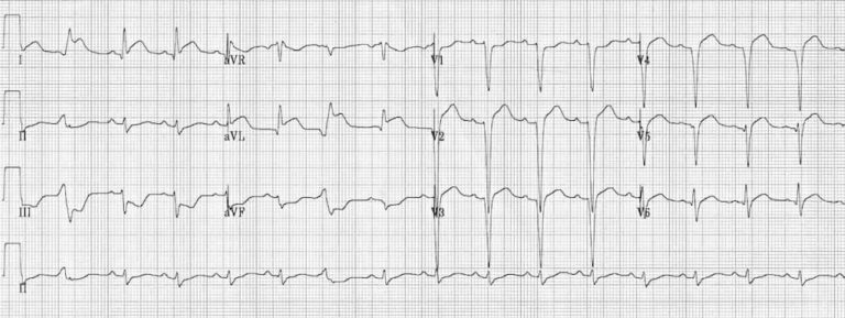 The ST Segment • LITFL • ECG Library Basics