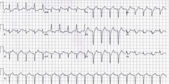 The ST Segment • LITFL • ECG Library Basics
