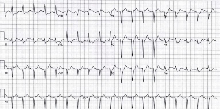 The ST Segment • LITFL • ECG Library Basics