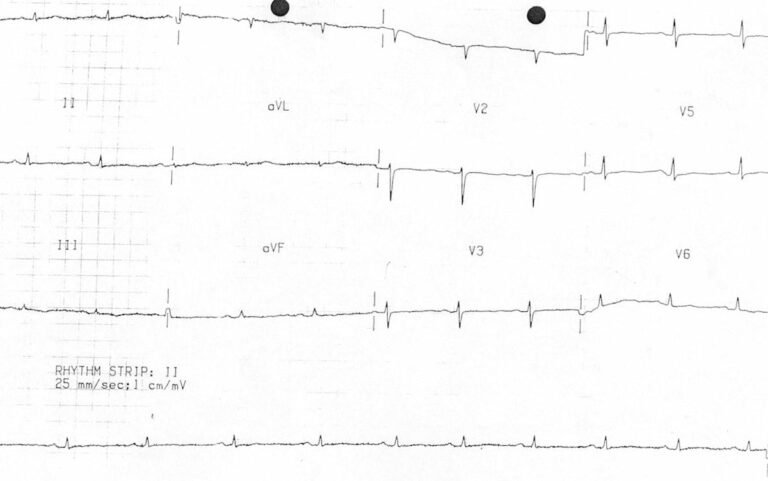 Hypothyroidism ECG changes • LITFL • ECG Library