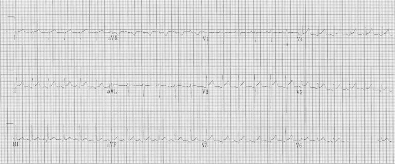 Myocarditis ECG changes • LITFL • ECG Library Diagnosis Myocarditis ECG changes • LITFL • ECG Library Diagnosis