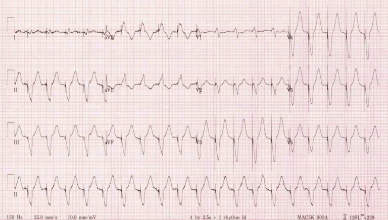 VT versus SVT • LITFL Medical Blog • ECG Library Basics