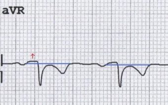PR segment • LITFL • ECG Library Basics