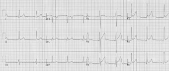 Benign Early Repolarisation • LITFL • ECG Library Diagnosis