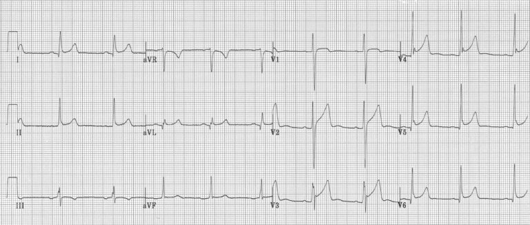 Benign Early Repolarisation • LITFL • ECG Library Diagnosis