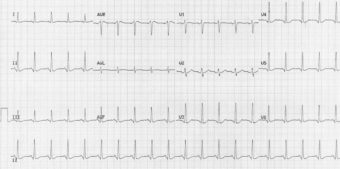 Quetiapine Toxicity • LITFL • ECG Library Diagnosis
