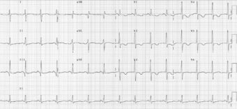 ECG changes in Pulmonary Embolism • LITFL • ECG Library