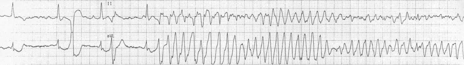 Polymorphic VT and Torsades de Pointes (TdP) • LITFL
