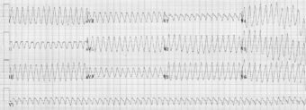 Ventricular Flutter Litfl Ecg Library Diagnosis Left Ventricular