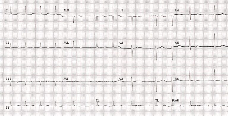 AV Block: 2nd degree, Mobitz I (Wenckebach Phenomenon) • LITFL