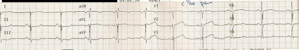 Wellens Syndrome • LITFL • ECG Library Eponym