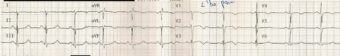 Wellens Syndrome • LITFL • ECG Library Eponym
