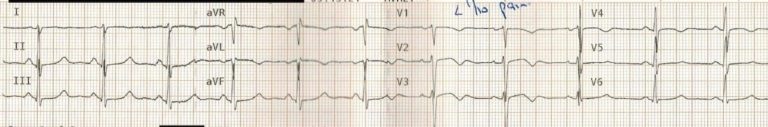 Wellens Syndrome • LITFL • ECG Library Eponym