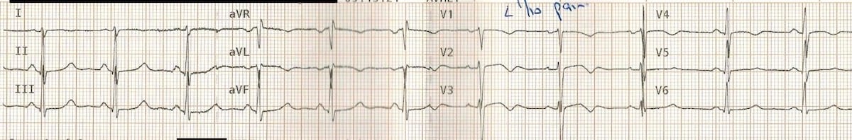 Wellens Syndrome • LITFL • ECG Library Eponym