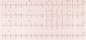 ECG Library Archives • Page 8 of 27 • Life in the Fast Lane • LITFL ...