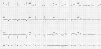 Low QRS Voltage • LITFL • ECG Library Diagnosis