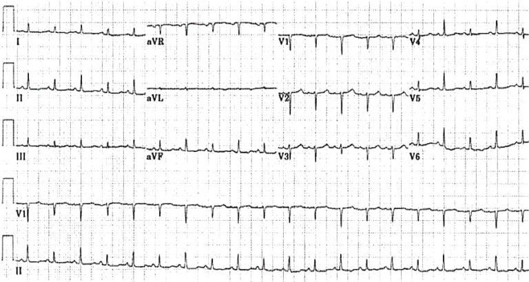 Low QRS Voltage • LITFL • ECG Library Diagnosis