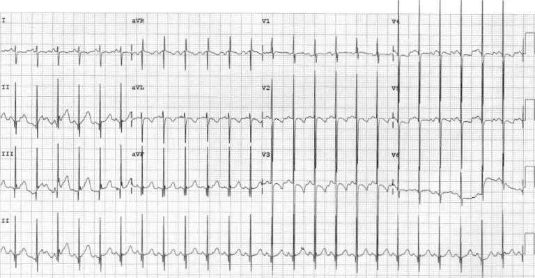 Biventricular Hypertrophy • LITFL • ECG Library Diagnosis