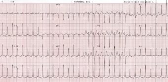 Supraventricular Tachycardia (SVT) • LITFL • ECG Library Diagnosis