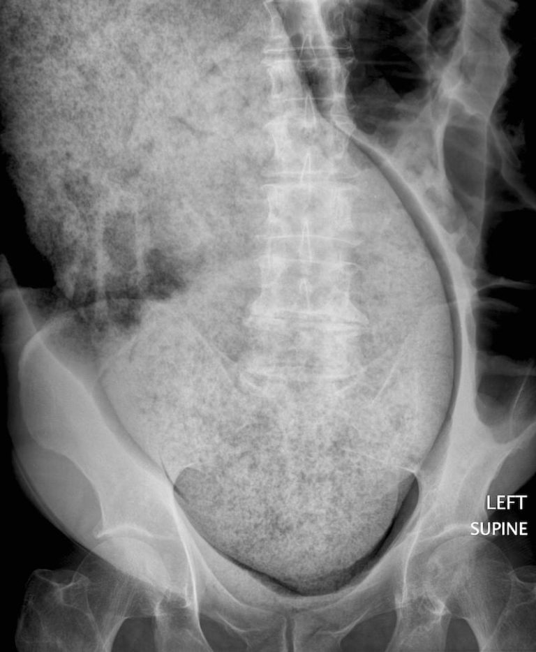 Top 10 X-Ray Foreign Bodies • LITFL • Arcanum veritas